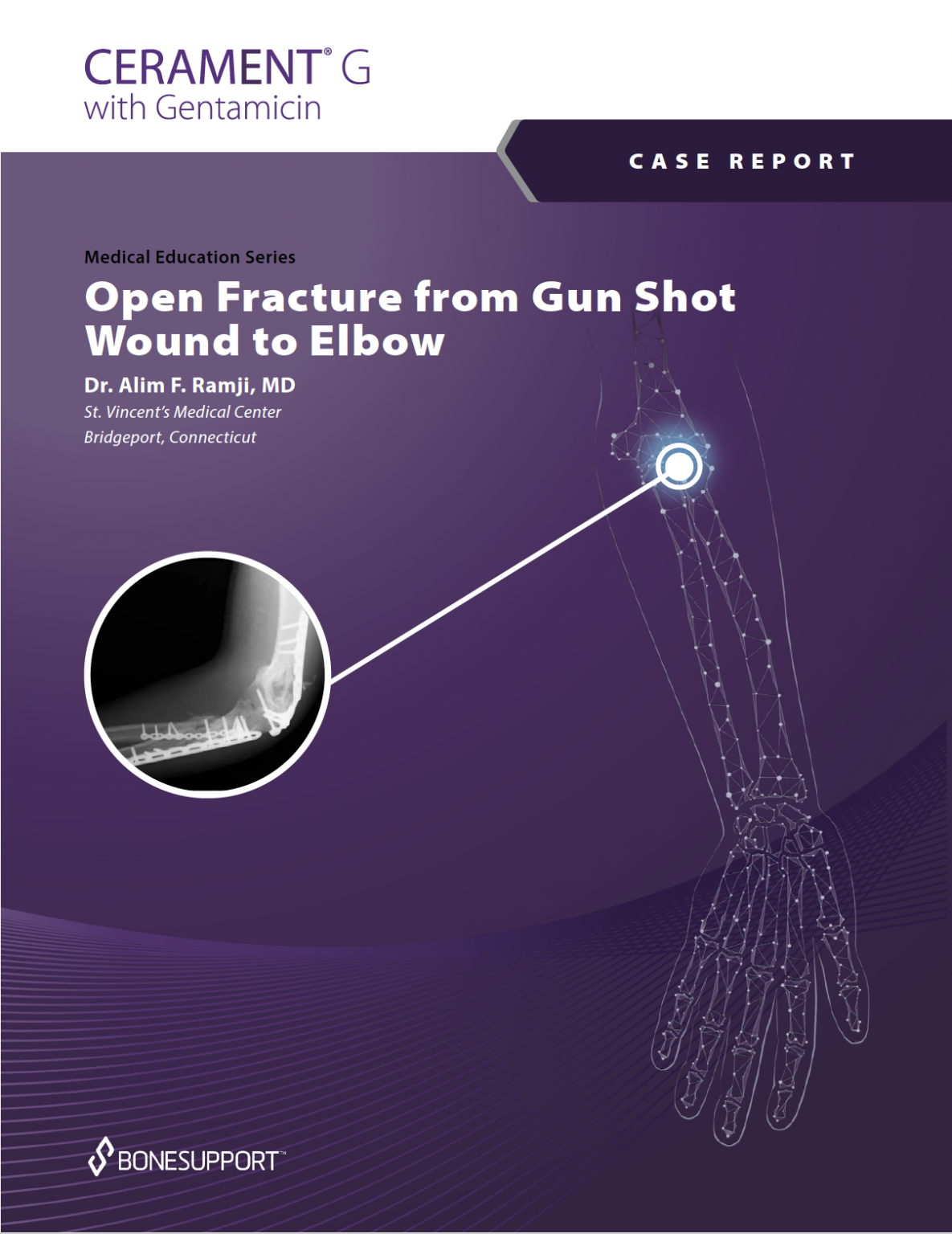 Open Fracture - BONESUPPORT